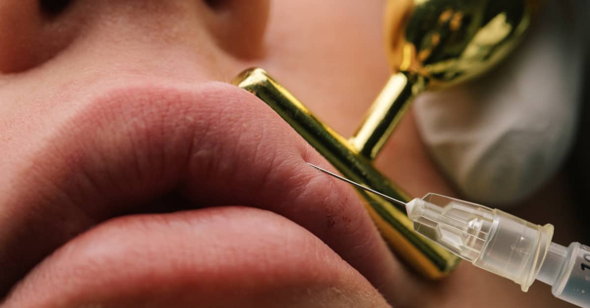 My Botched Lip Filler Formed A Cyst, And Now I'm Getting It Popped